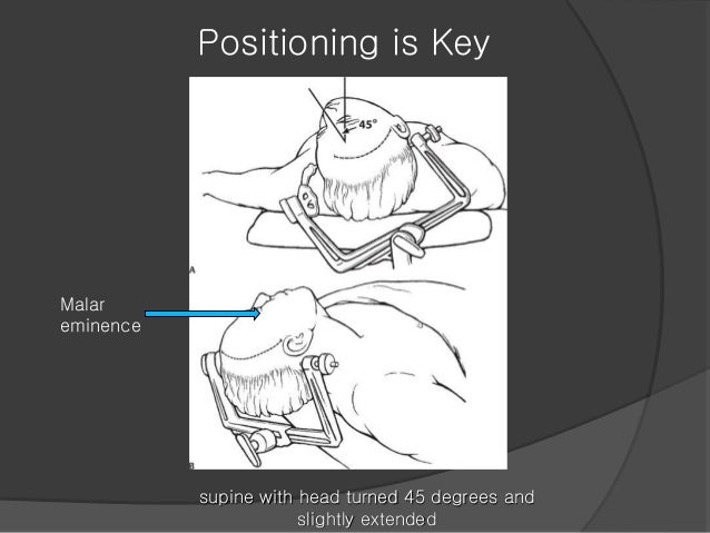 Basilar approaches Azam Basheer MD 9-2-14