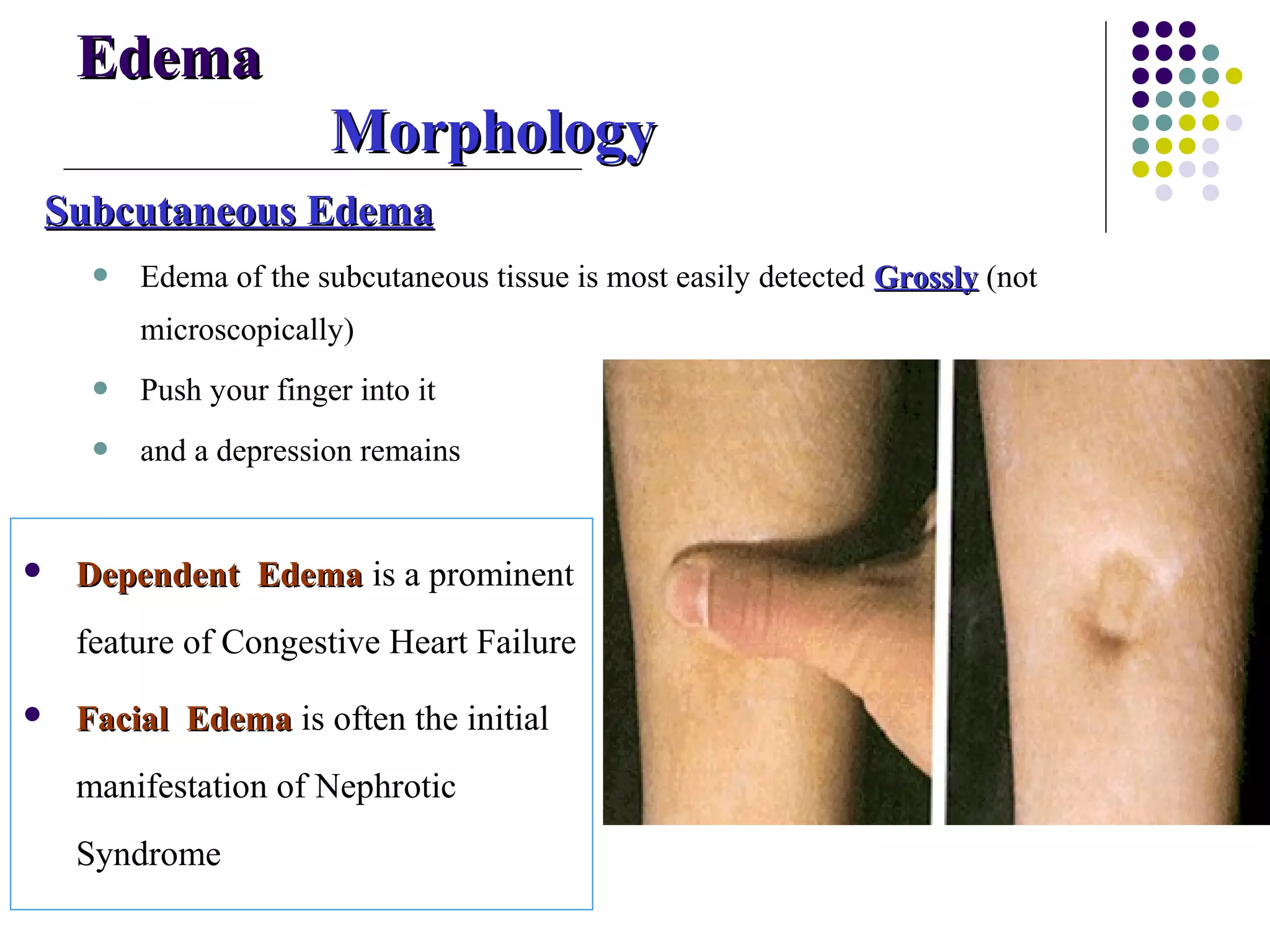 64965 hemodyn[1] edema | PPT