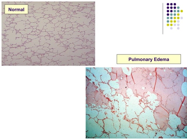 64965 hemodyn[1] edema | PPT | Heart and Cardiovascular Diseases ...