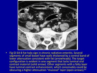 64 attenuation patterns in the abnormal bowel wall | PPT