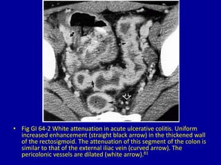 64 attenuation patterns in the abnormal bowel wall | PPT