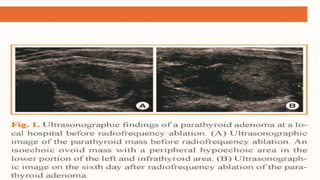 hyperparathyroidism | PPTX | Thyroid Disorders | Endocrine and ...