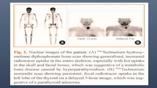 hyperparathyroidism | PPTX | Thyroid Disorders | Endocrine and ...