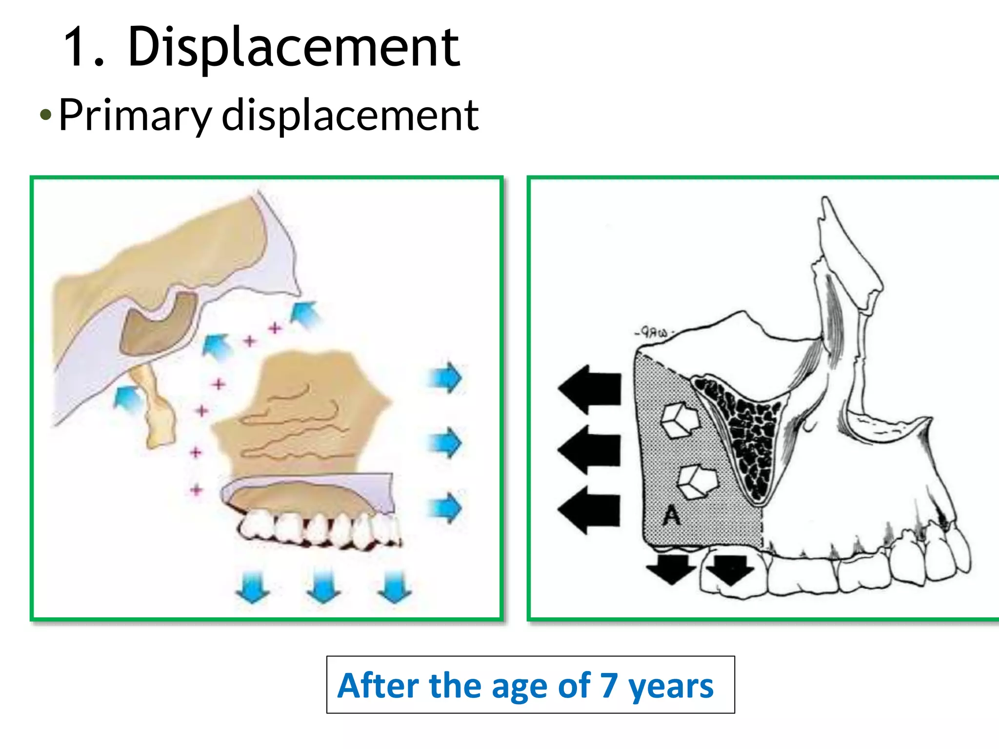Growth of maxilla | PPTX