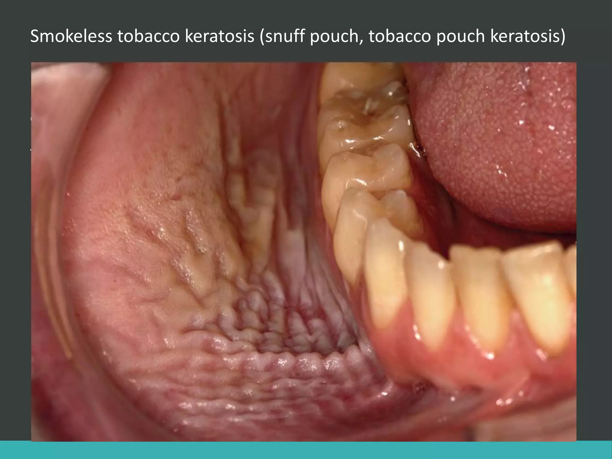 White Lesions Of Oral Cavity Pptx