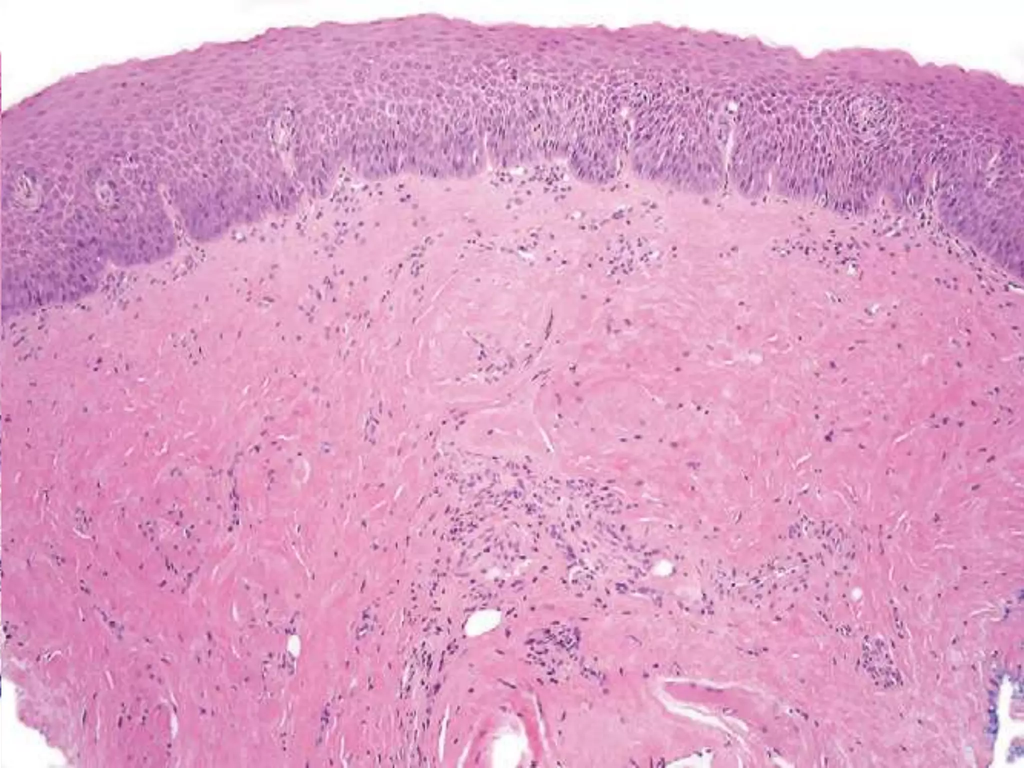 White Lesions Of Oral Cavity Pptx 3740
