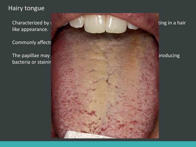 White lesions of oral cavity | PPTX | Dental Health | Diseases and ...