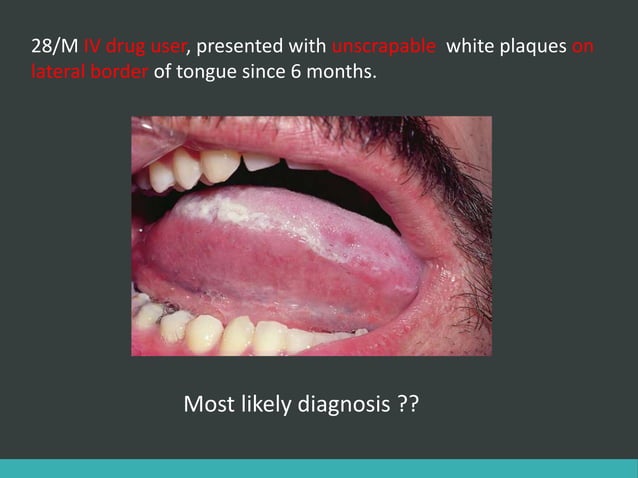 White lesions of oral cavity | PPTX | Dental Health | Diseases and ...