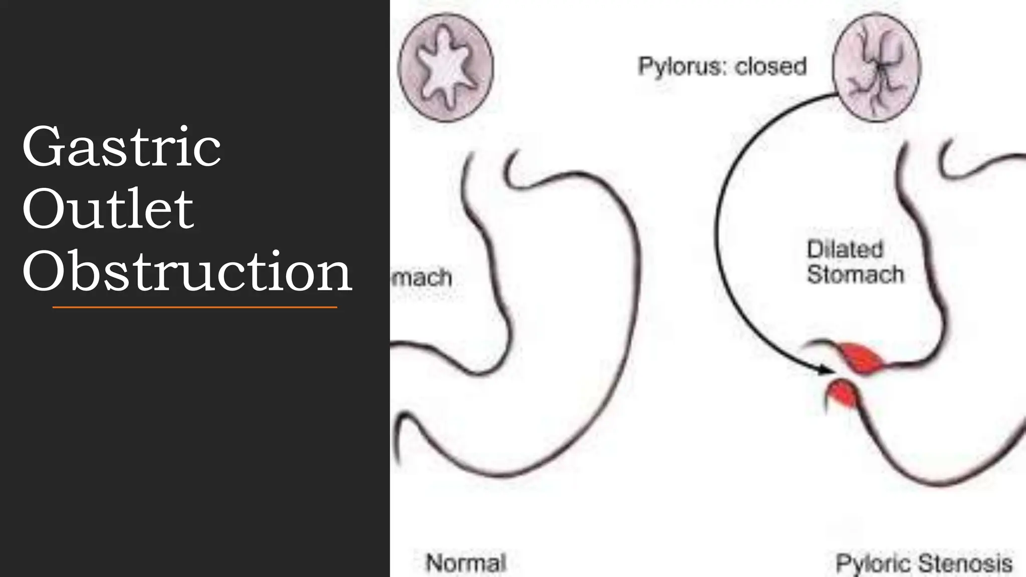 659571282-Gastric-Outlet-Obstruction-Soltan-Aiman-Neazy-PPT.pptx