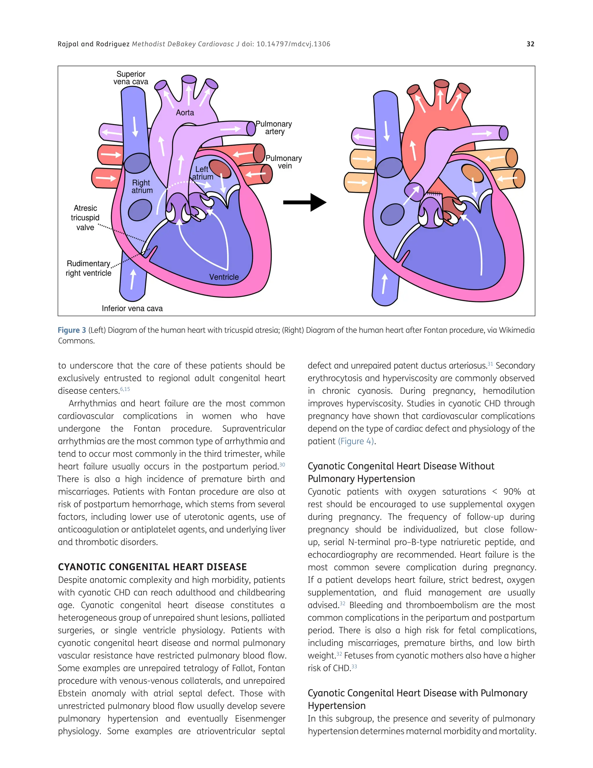 High risk congenital heart disease in pregnancy.pdf