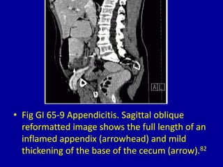 65 ileocecal diseases on computed tomography | PPTX