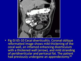 65 ileocecal diseases on computed tomography | PPTX