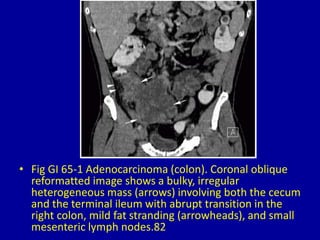 65 ileocecal diseases on computed tomography | PPTX