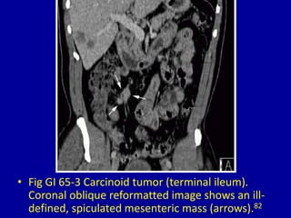 65 ileocecal diseases on computed tomography | PPTX