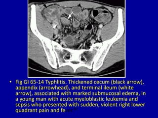 65 ileocecal diseases on computed tomography | PPTX