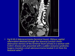 65 ileocecal diseases on computed tomography | PPTX