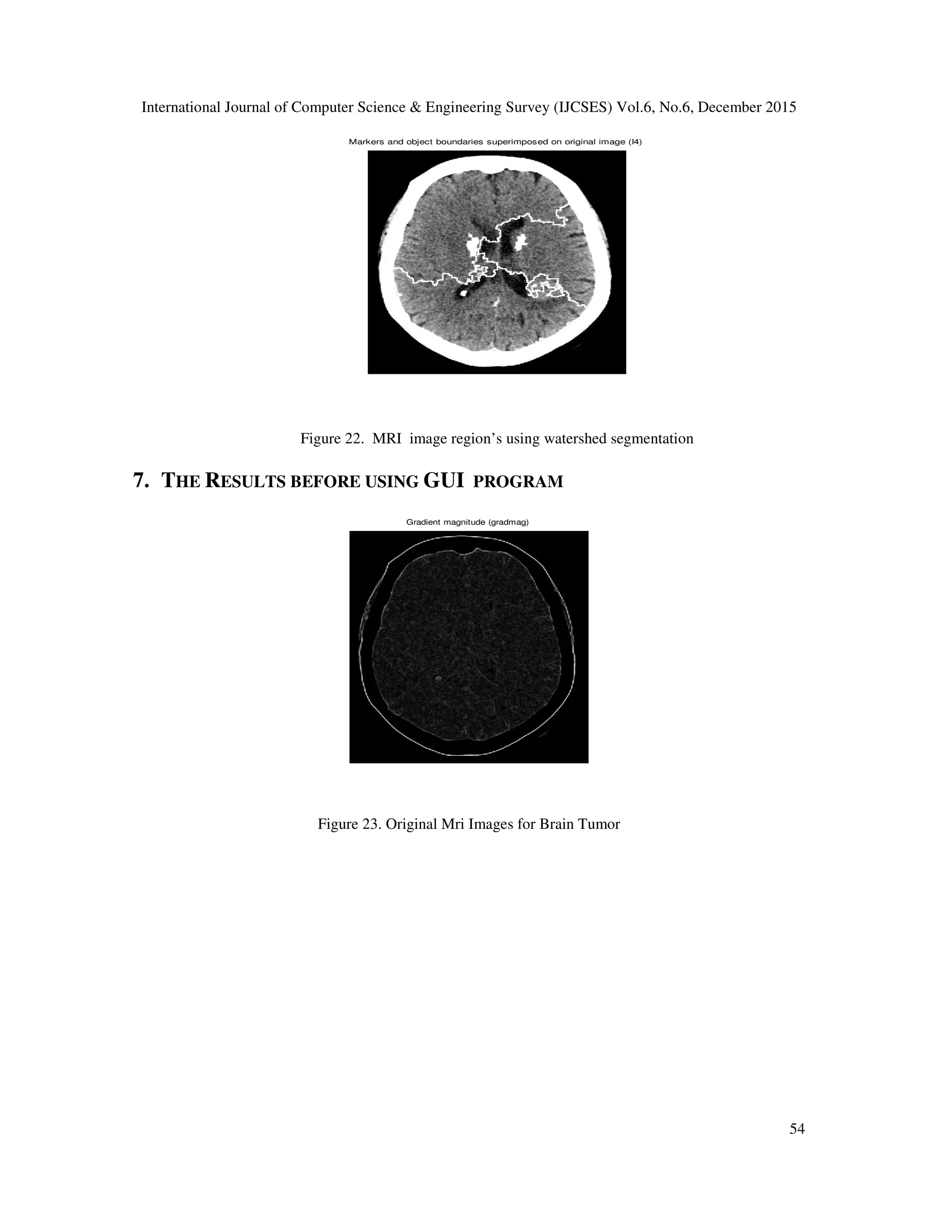 Detecting Brain Tumour From Mri Image Using Matlab Gui Programme Pdf