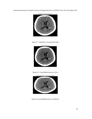 DETECTING BRAIN TUMOUR FROM MRI IMAGE USING MATLAB GUI PROGRAMME | PDF