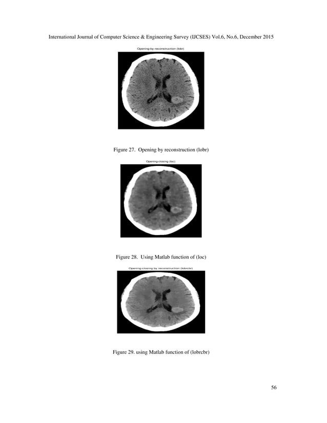 DETECTING BRAIN TUMOUR FROM MRI IMAGE USING MATLAB GUI PROGRAMME | PDF
