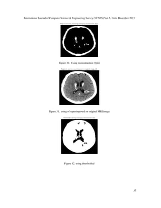 DETECTING BRAIN TUMOUR FROM MRI IMAGE USING MATLAB GUI PROGRAMME | PDF