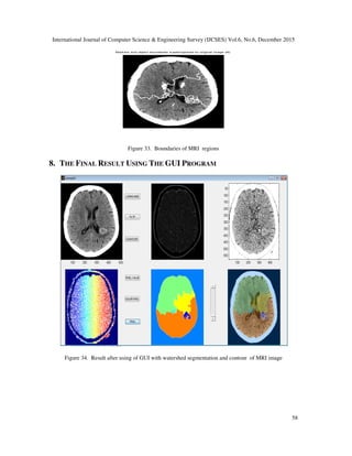 DETECTING BRAIN TUMOUR FROM MRI IMAGE USING MATLAB GUI PROGRAMME | PDF