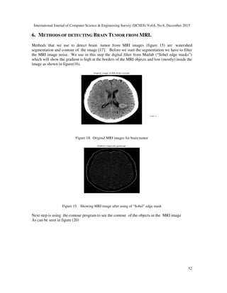 DETECTING BRAIN TUMOUR FROM MRI IMAGE USING MATLAB GUI PROGRAMME | PDF