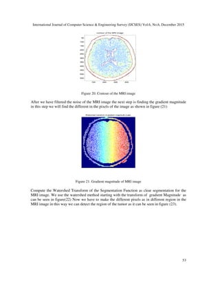 DETECTING BRAIN TUMOUR FROM MRI IMAGE USING MATLAB GUI PROGRAMME | PDF