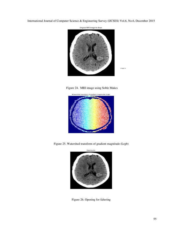 DETECTING BRAIN TUMOUR FROM MRI IMAGE USING MATLAB GUI PROGRAMME | PDF