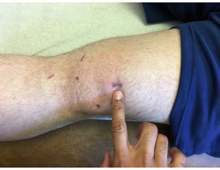 minimally invasive quad tendon harvest scar for ACL reconstruction | PPT