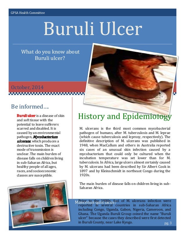 buruli ulcer