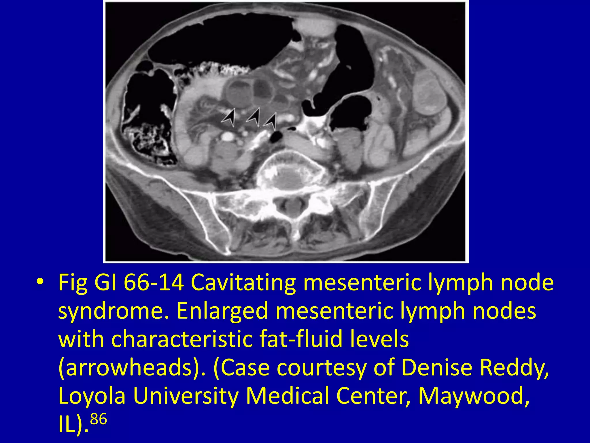 66 mesenteric lymph node enlargement | PPTX