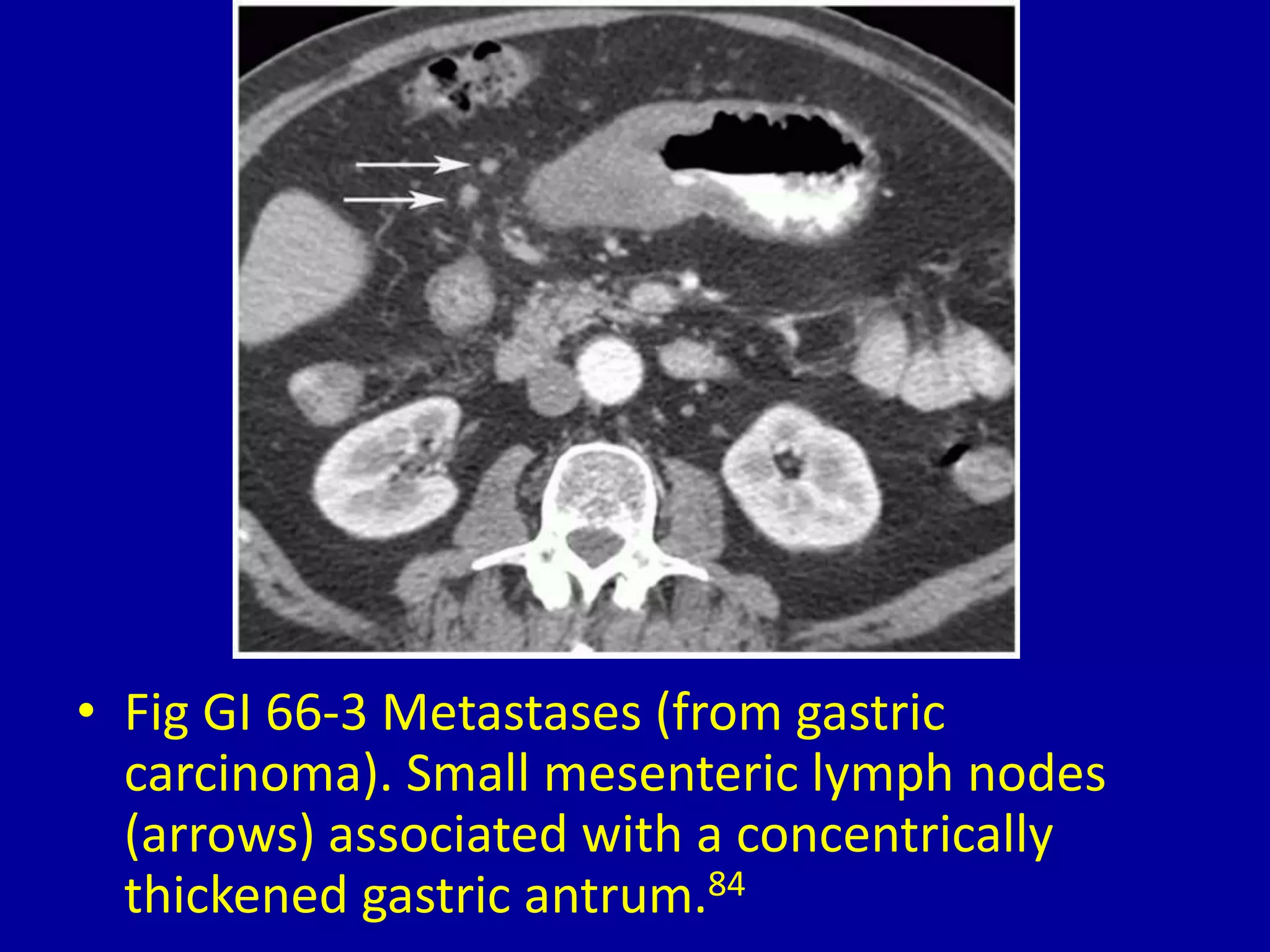 66 mesenteric lymph node enlargement | PPTX