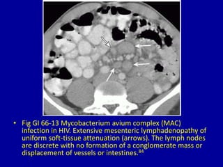 66 mesenteric lymph node enlargement | PPT