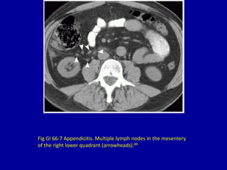 66 mesenteric lymph node enlargement | PPTX