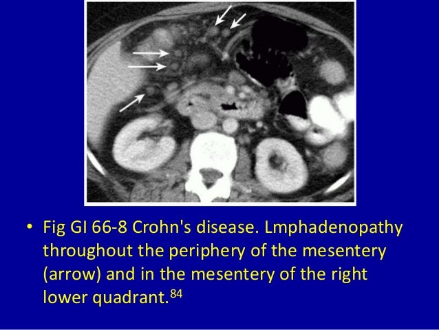66 Mesenteric Lymph Node Enlargement