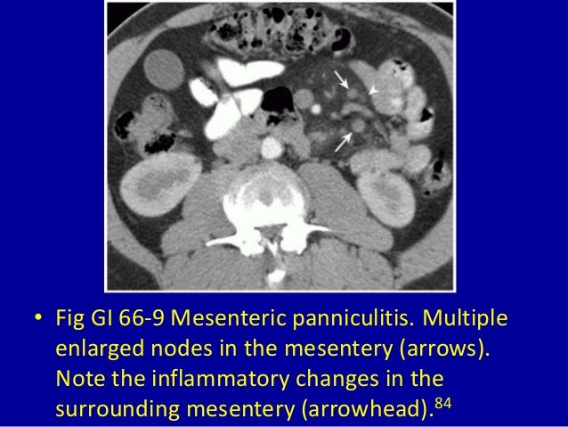 66 Mesenteric Lymph Node Enlargement