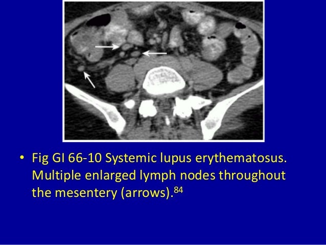 66 Mesenteric Lymph Node Enlargement