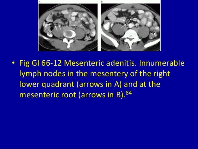 66 Mesenteric Lymph Node Enlargement