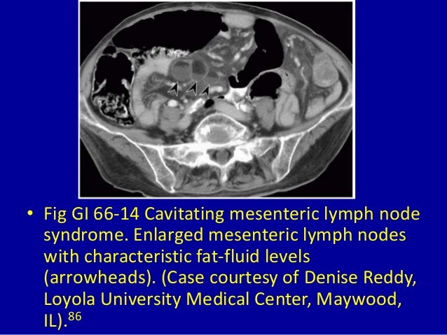 66 Mesenteric Lymph Node Enlargement