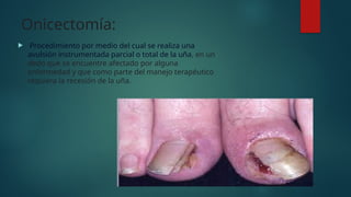 Técnica quirúrgica onicectomia complicaciones pptx | PPTX