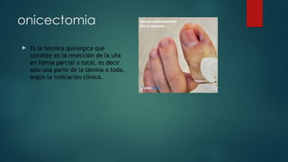 Técnica quirúrgica onicectomia complicaciones pptx | PPTX
