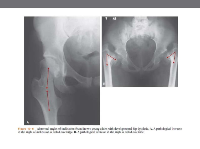 BIOMECHANICS OF HIP JOINT BY Dr. VIKRAM | PPTX