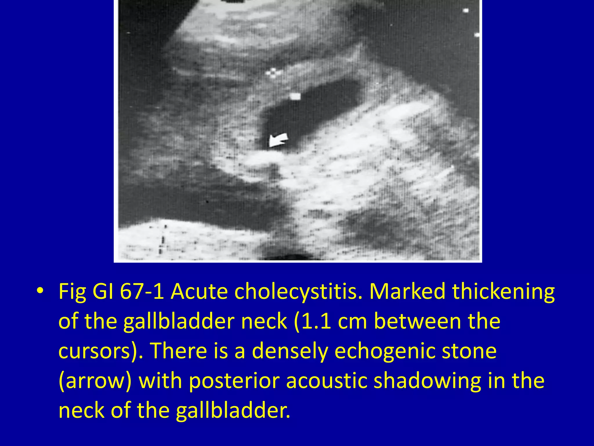 67 thickened gallbladder wall ( | PPTX