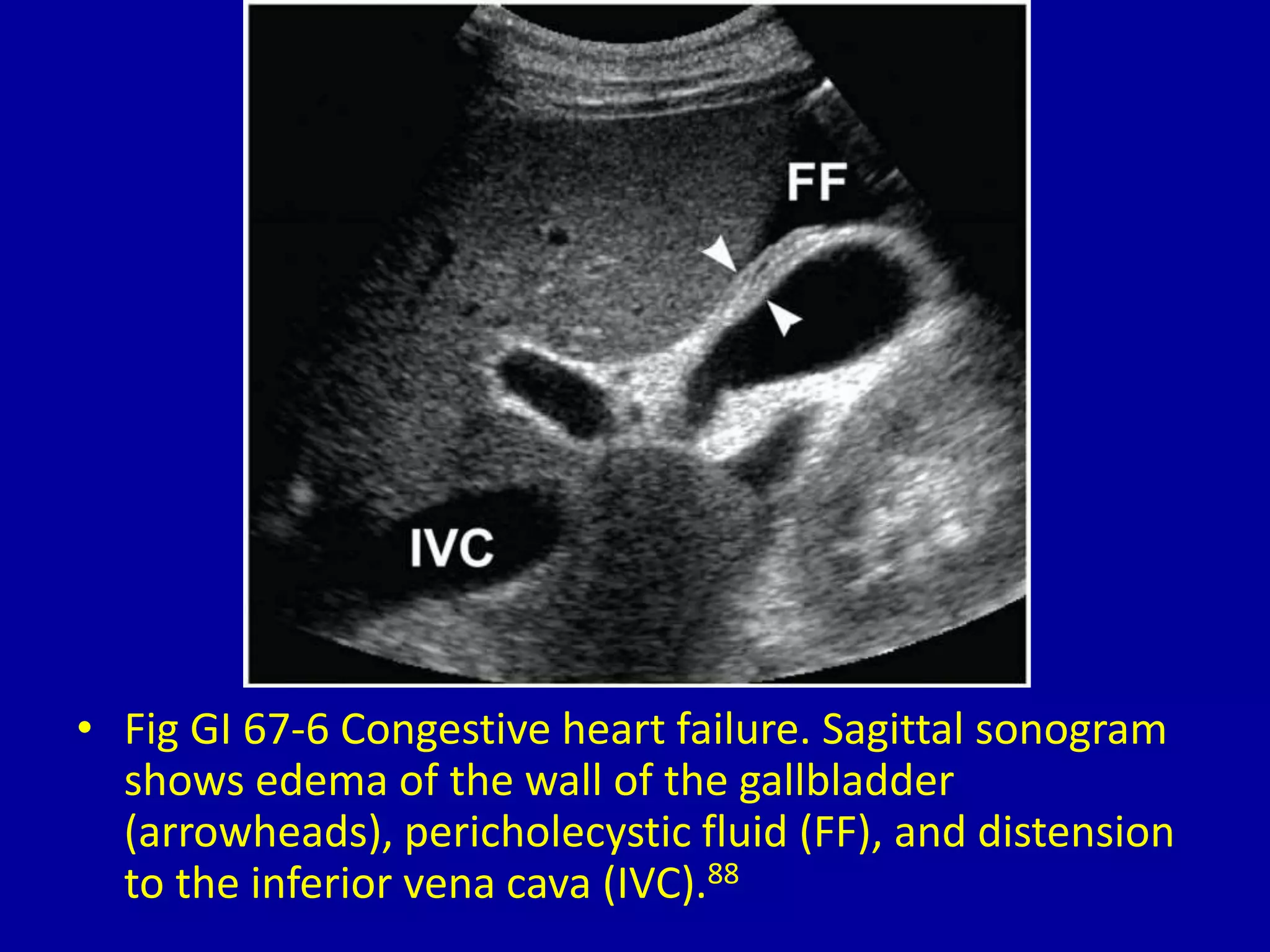 67 thickened gallbladder wall ( | PPTX