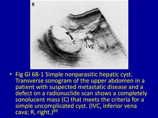 68 focal anechoic (cystic) liver masses | PPT