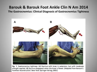Gastroc Equinus Contracture Icd 9