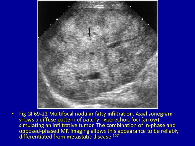 69 complex or solid liver masses | PPTX