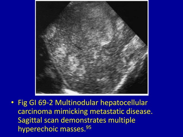 69 complex or solid liver masses | PPTX