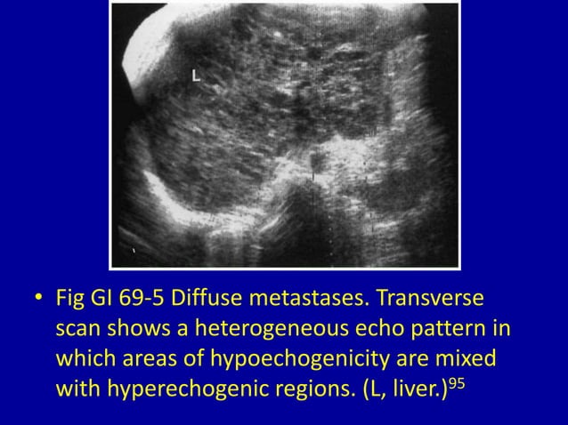 69 complex or solid liver masses | PPTX