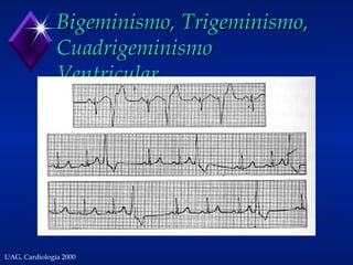 6 arritmias ventriculares | PPT